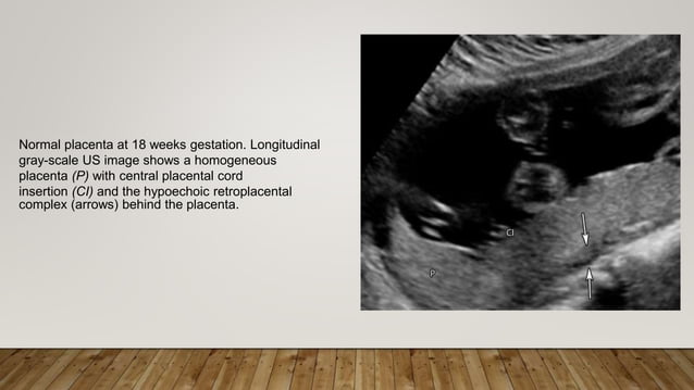 Placenta types and grading | PPTX | Pregnancy | Reproductive Health