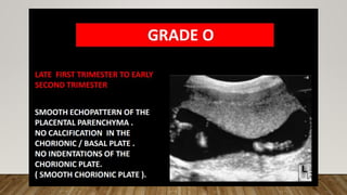 Placenta types and grading | PPTX