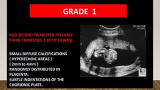 Placenta types and grading | PPTX