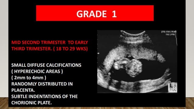 Placenta types and grading | PPTX | Pregnancy | Reproductive Health
