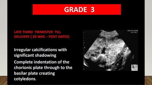 Placenta types and grading | PPTX | Pregnancy | Reproductive Health