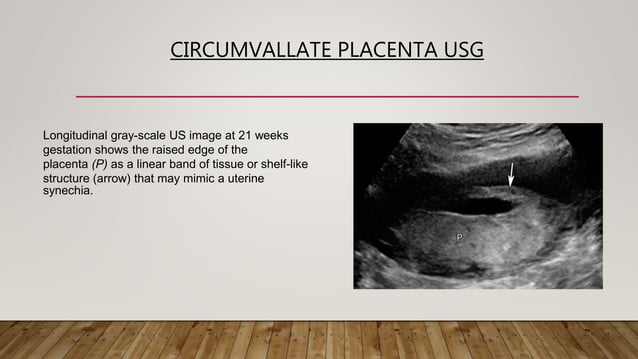 Placenta types and grading | PPTX | Pregnancy | Reproductive Health