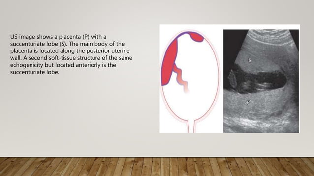 Placenta types and grading | PPTX | Pregnancy | Reproductive Health