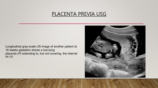 Placenta types and grading | PPTX | Pregnancy | Reproductive Health