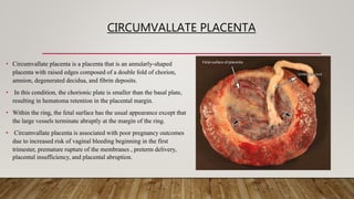 Ring Shaped Placenta
