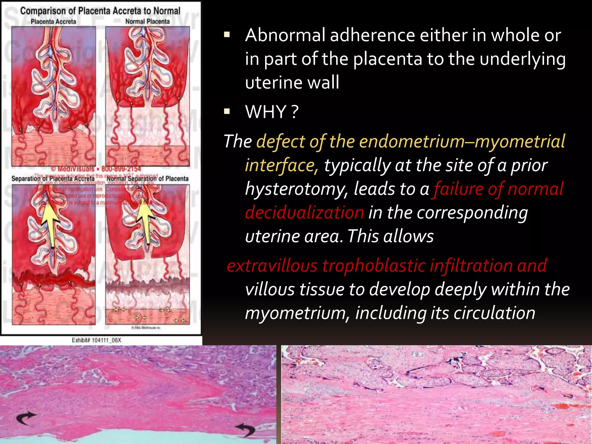 Placeta accreta syndrome | PPTX