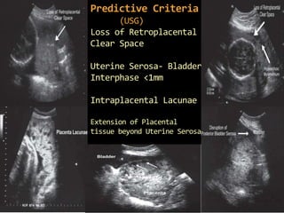 Placeta accreta syndrome | PPTX