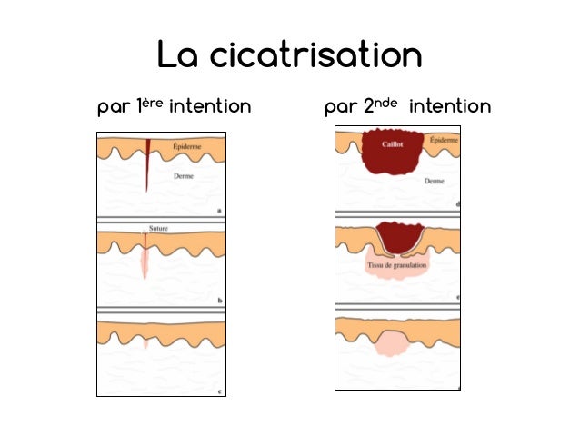 Plaies et Cicatrisation