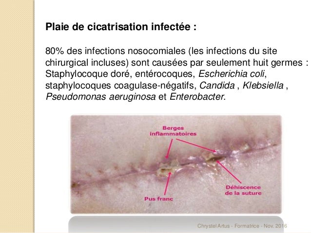 Plaie et cicatrisation