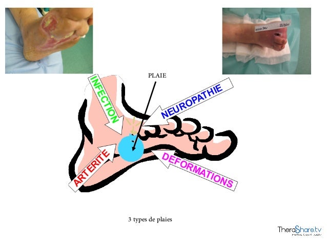 Plaies et cicatrisation : Apprendre à mieux soigner