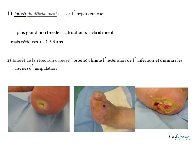 Plaies et cicatrisation : Apprendre à mieux soigner