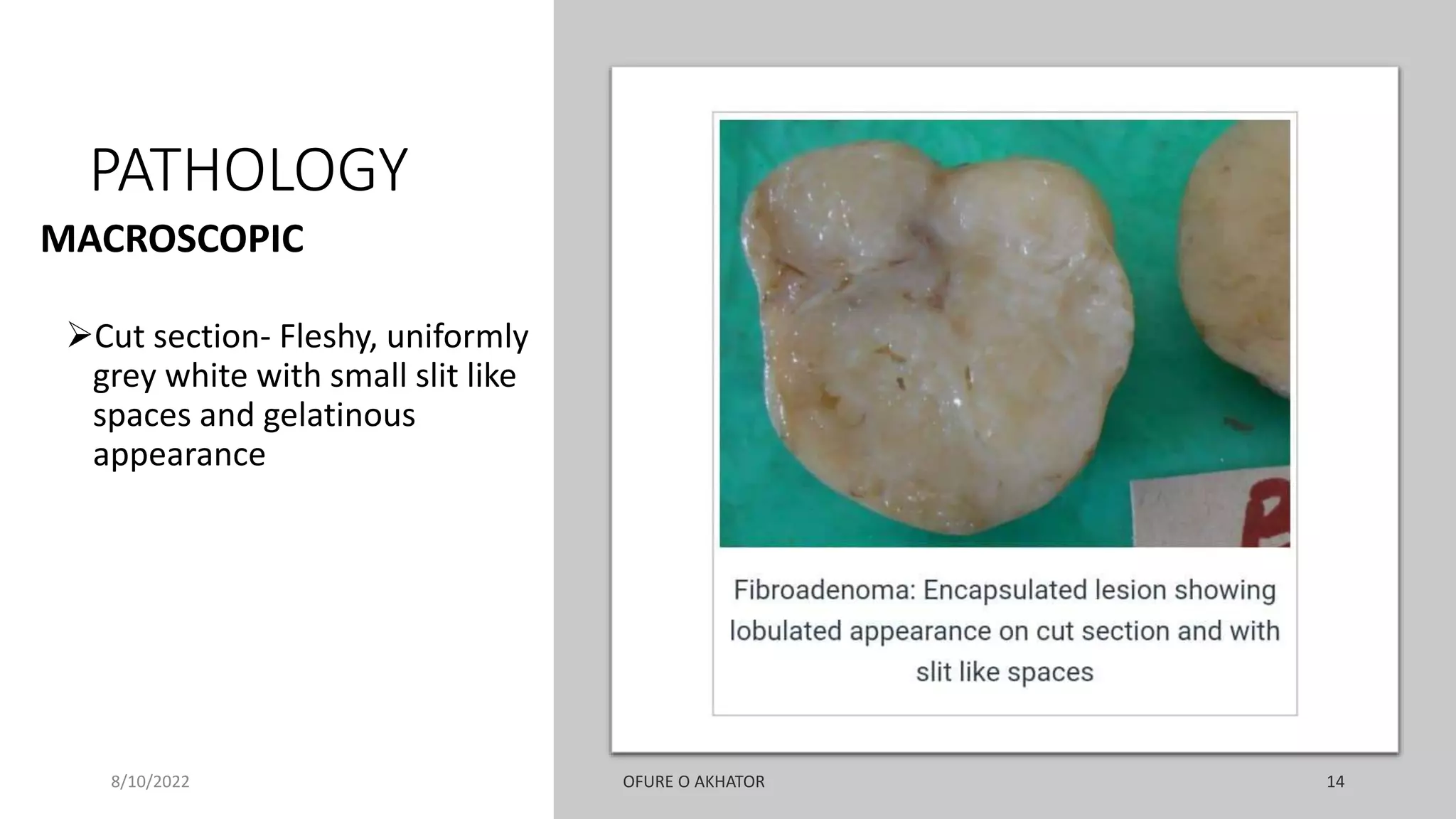 DESCRIBE THE SURGICAL PATHOLOGY AND PATHOPHYSIOLOGY OF FIBROADENOMA.pptx