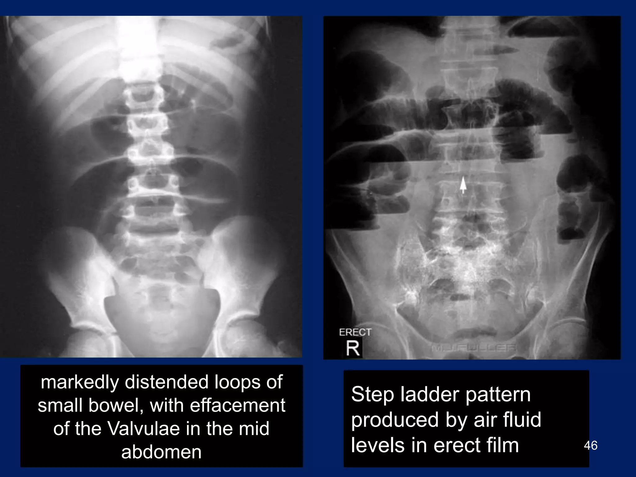 Plain picture in acute abdomen | PPTX