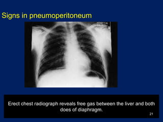 Plain picture in acute abdomen | PPTX