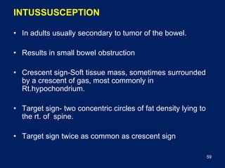 Plain picture in acute abdomen | PPTX