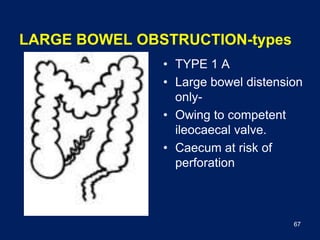 Plain picture in acute abdomen | PPTX