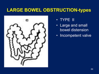 Plain picture in acute abdomen | PPTX