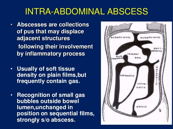 Plain picture in acute abdomen