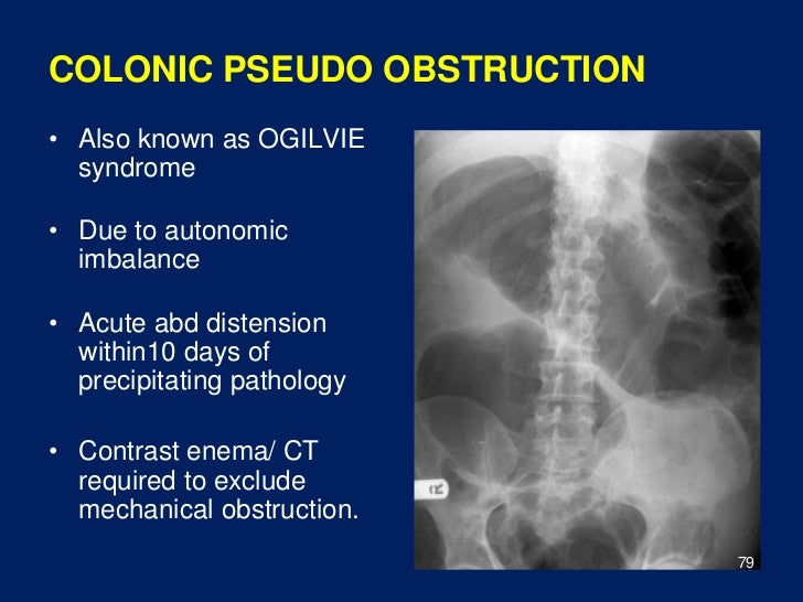 Plain picture in acute abdomen