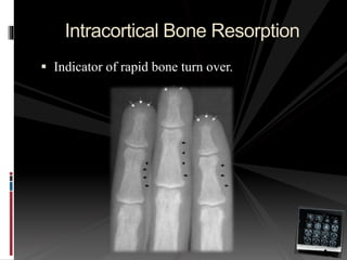 Plain radiological findings of primary hyperparathyrodism | PPTX
