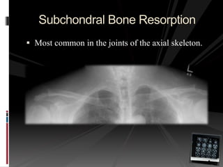 Plain radiological findings of primary hyperparathyrodism | PPTX