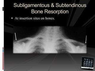 Plain radiological findings of primary hyperparathyrodism | PPTX