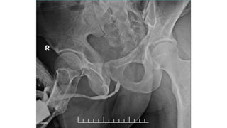 PLAIN XRAY KUB AUG MCU CLASS urology ppt | PPTX