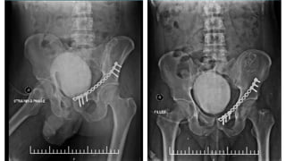 PLAIN XRAY KUB AUG MCU CLASS urology ppt | PPTX