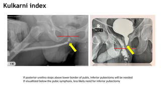 PLAIN XRAY KUB AUG MCU CLASS urology ppt | PPTX