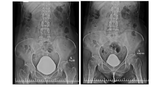 PLAIN XRAY KUB AUG MCU CLASS urology ppt | PPTX