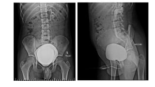 PLAIN XRAY KUB AUG MCU CLASS urology ppt | PPTX