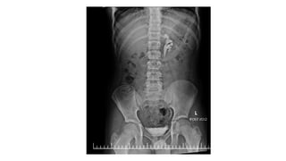 PLAIN XRAY KUB AUG MCU CLASS urology ppt | PPTX