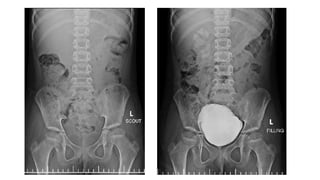PLAIN XRAY KUB AUG MCU CLASS urology ppt | PPTX