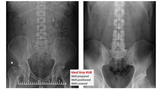 PLAIN XRAY KUB AUG MCU CLASS urology ppt | PPTX
