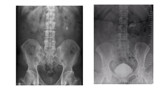 PLAIN XRAY KUB AUG MCU CLASS urology ppt | PPTX