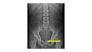 PLAIN XRAY KUB AUG MCU CLASS urology ppt | PPTX