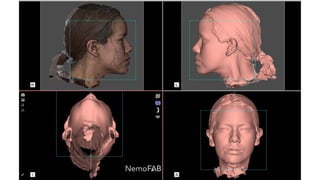 PLANEACION VIRTUAL DE CIRUGIA ORTOGNATICA NEMOFAB | PPTX