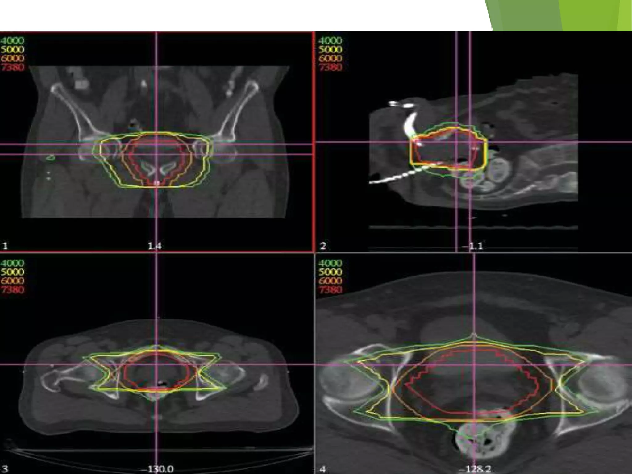 Plan evaluation in Radiotherapy- Dr Kiran | PPTX