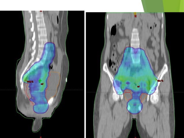 Plan evaluation in Radiotherapy- Dr Kiran | PPTX | Physics | Science