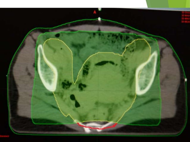 Plan evaluation in Radiotherapy- Dr Kiran | PPTX | Physics | Science