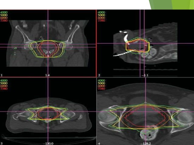 Plan evaluation in Radiotherapy- Dr Kiran | PPTX | Physics | Science