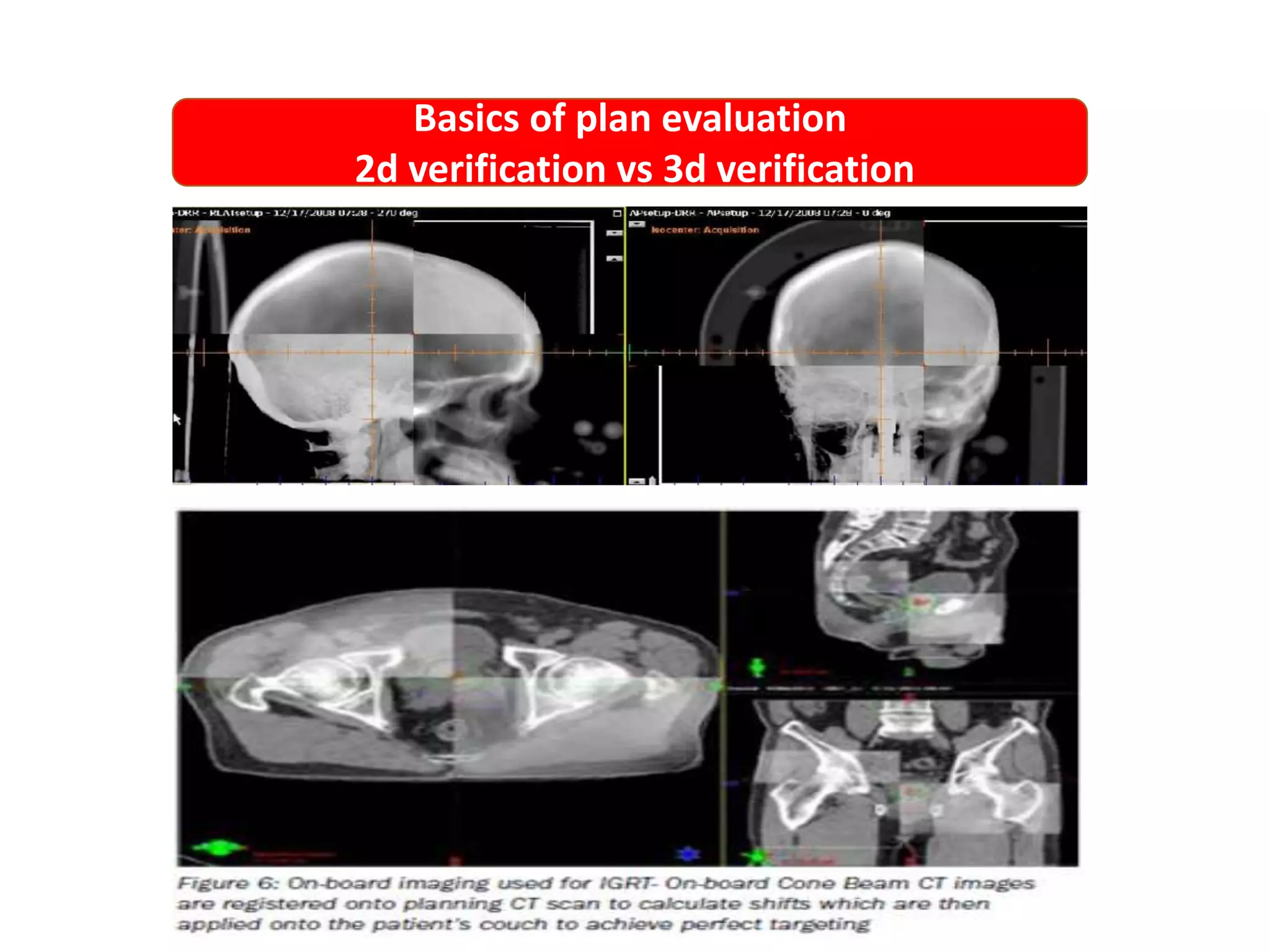 Plan evaluation in RADIOTHERAPY | PPTX