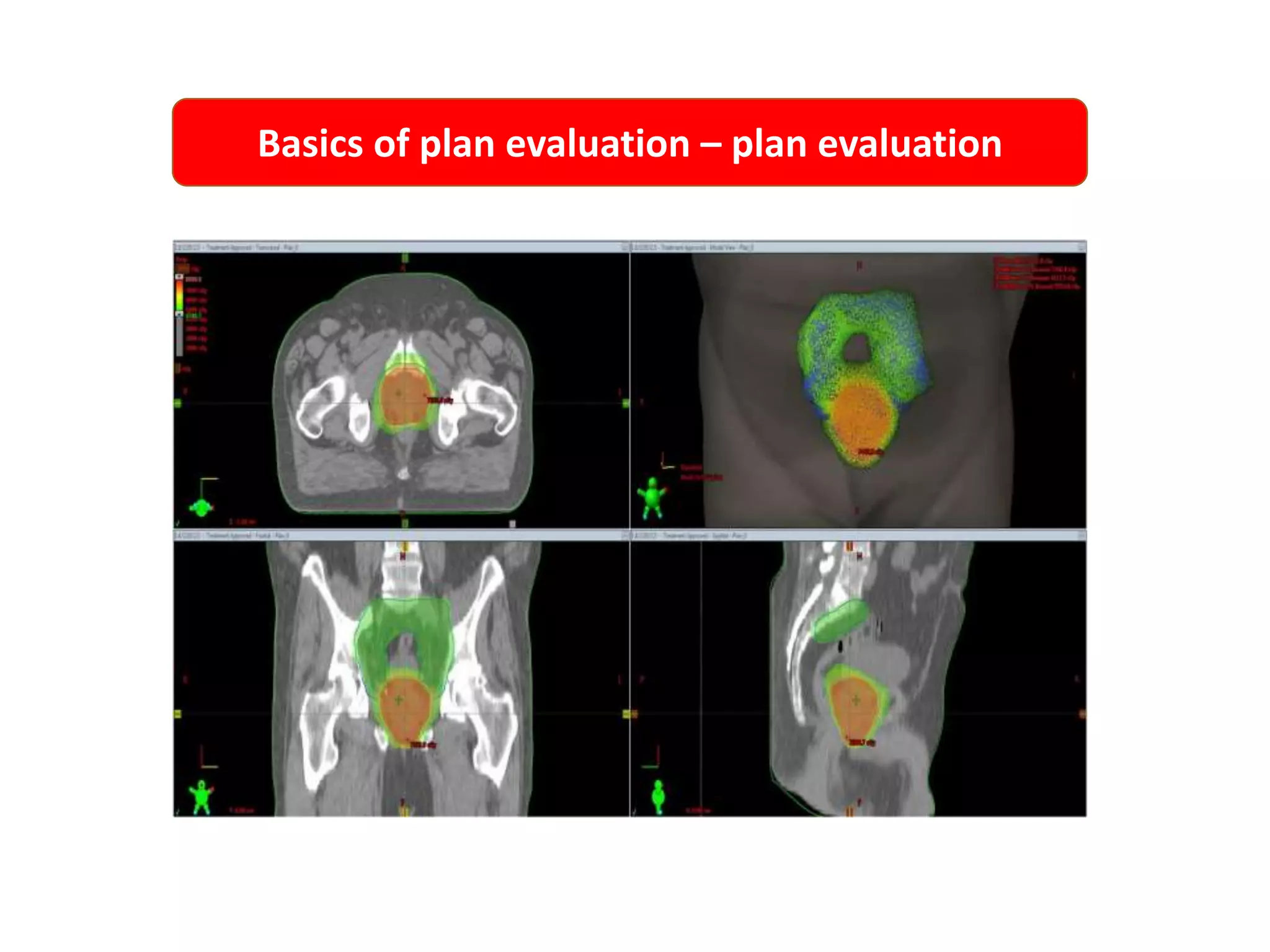 Plan evaluation in RADIOTHERAPY | PPTX