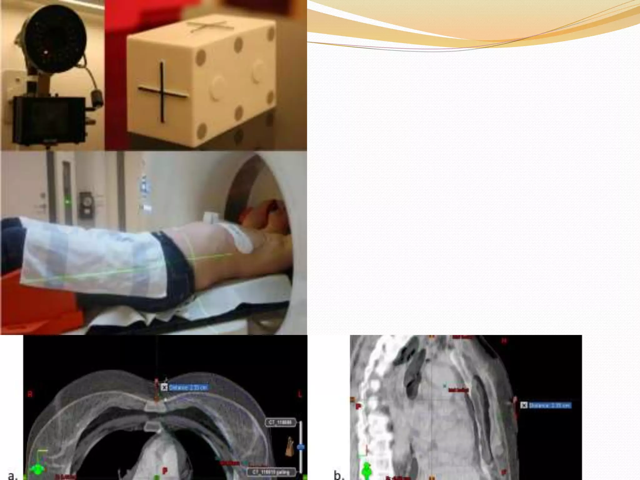 Breast Cancer Radiation Therapy: RT Plan evaluation & Recent Advances ...