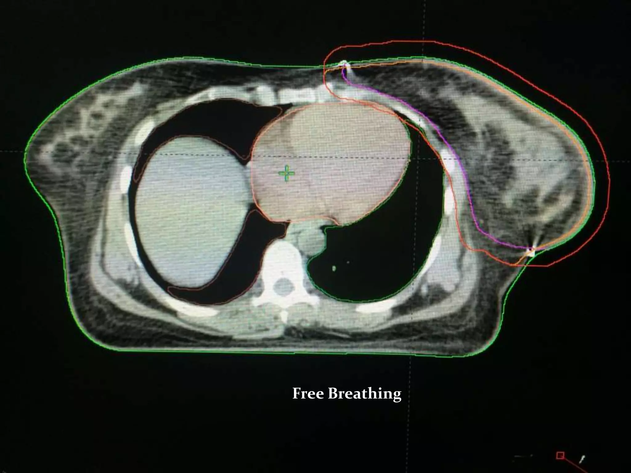 Breast Cancer Radiation Therapy: RT Plan evaluation & Recent Advances ...