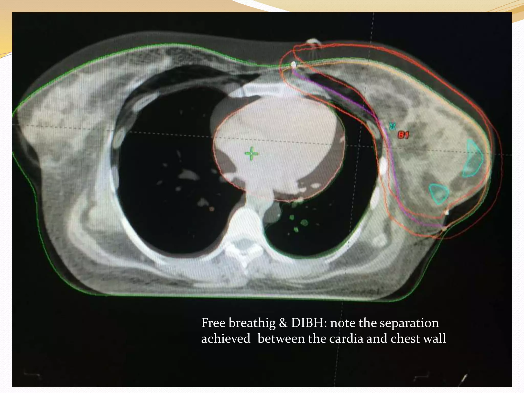 Breast Cancer Radiation Therapy: RT Plan evaluation & Recent Advances ...