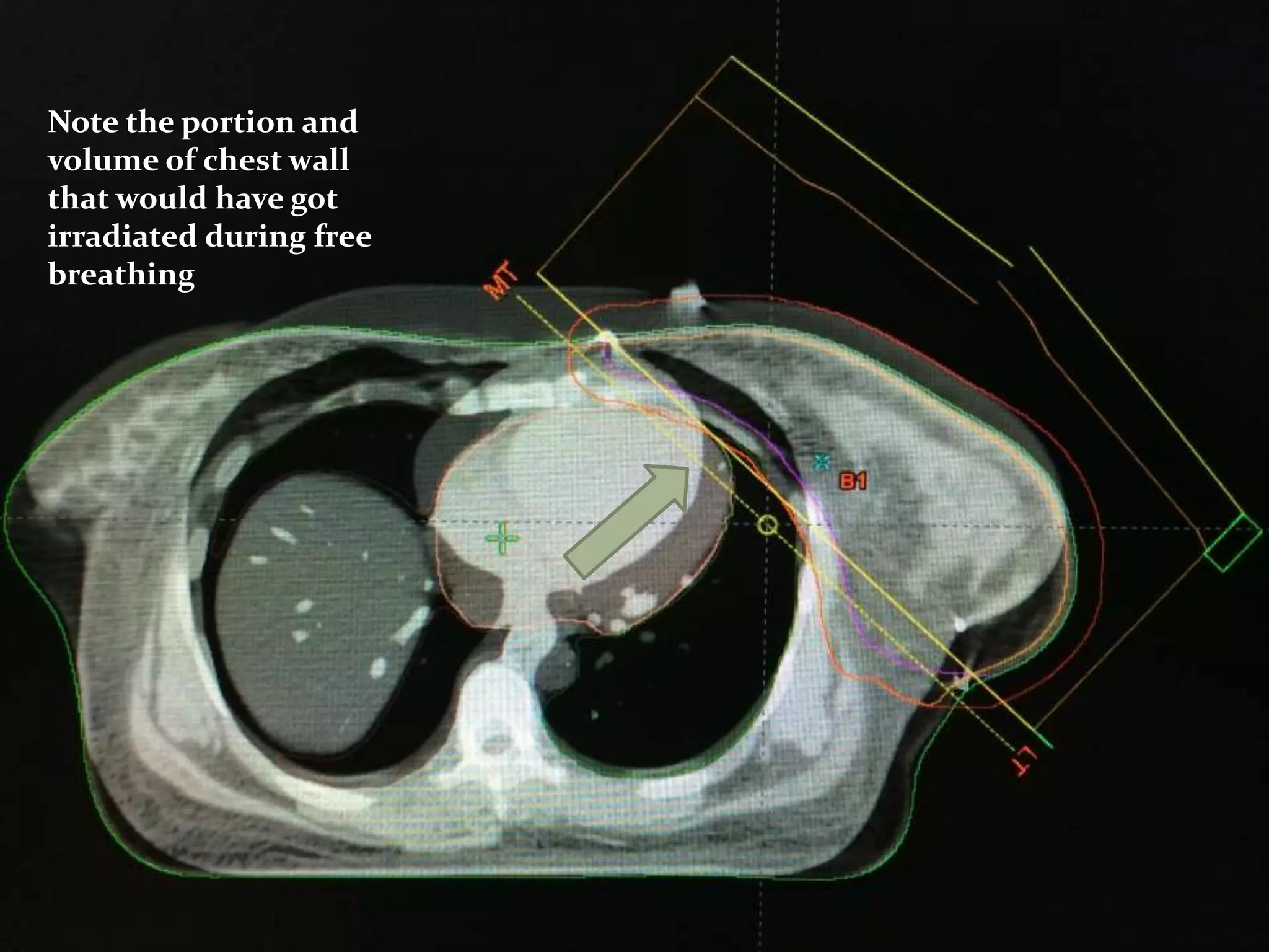 Breast Cancer Radiation Therapy: RT Plan evaluation & Recent Advances ...