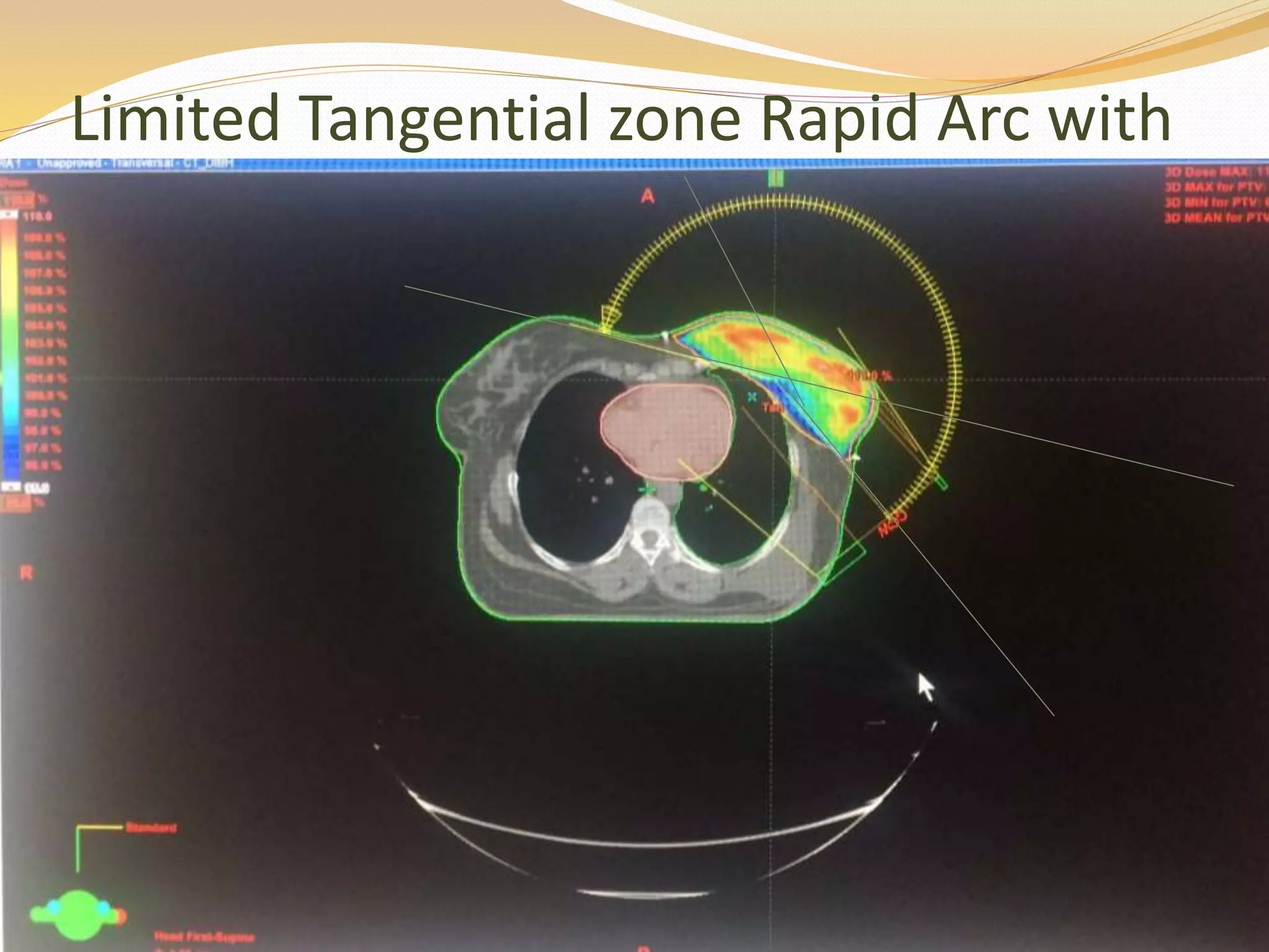 Breast Cancer Radiation Therapy: RT Plan evaluation & Recent Advances - 4DCT & Respiratory ...