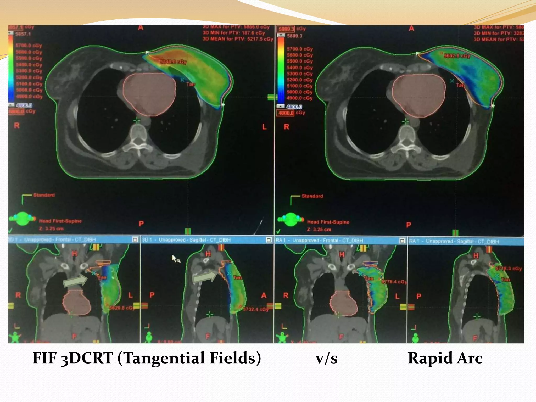 Breast Cancer Radiation Therapy: RT Plan evaluation & Recent Advances ...