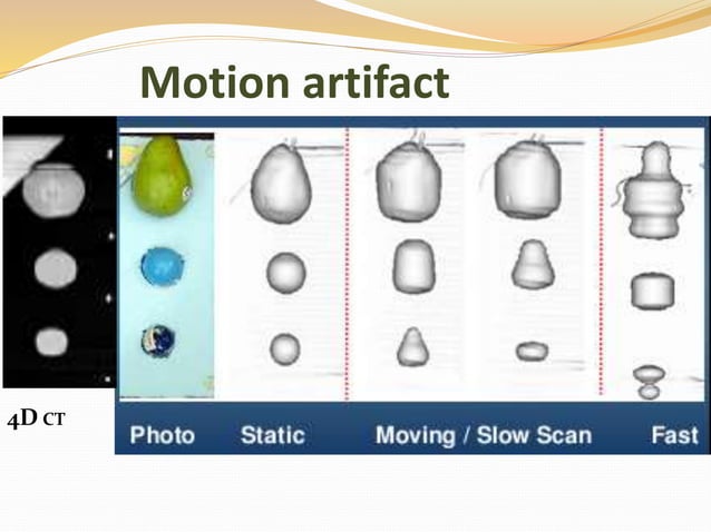 Breast Cancer Radiation Therapy: RT Plan evaluation & Recent Advances ...